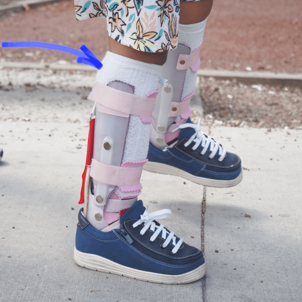 Des chaussettes adaptées pour le port des orthèses tibiales - En santé ...